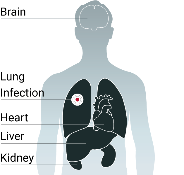 Physiology of sepsis - Sepsis Amsterdam