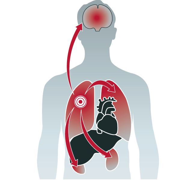 Physiology of sepsis - Sepsis Amsterdam